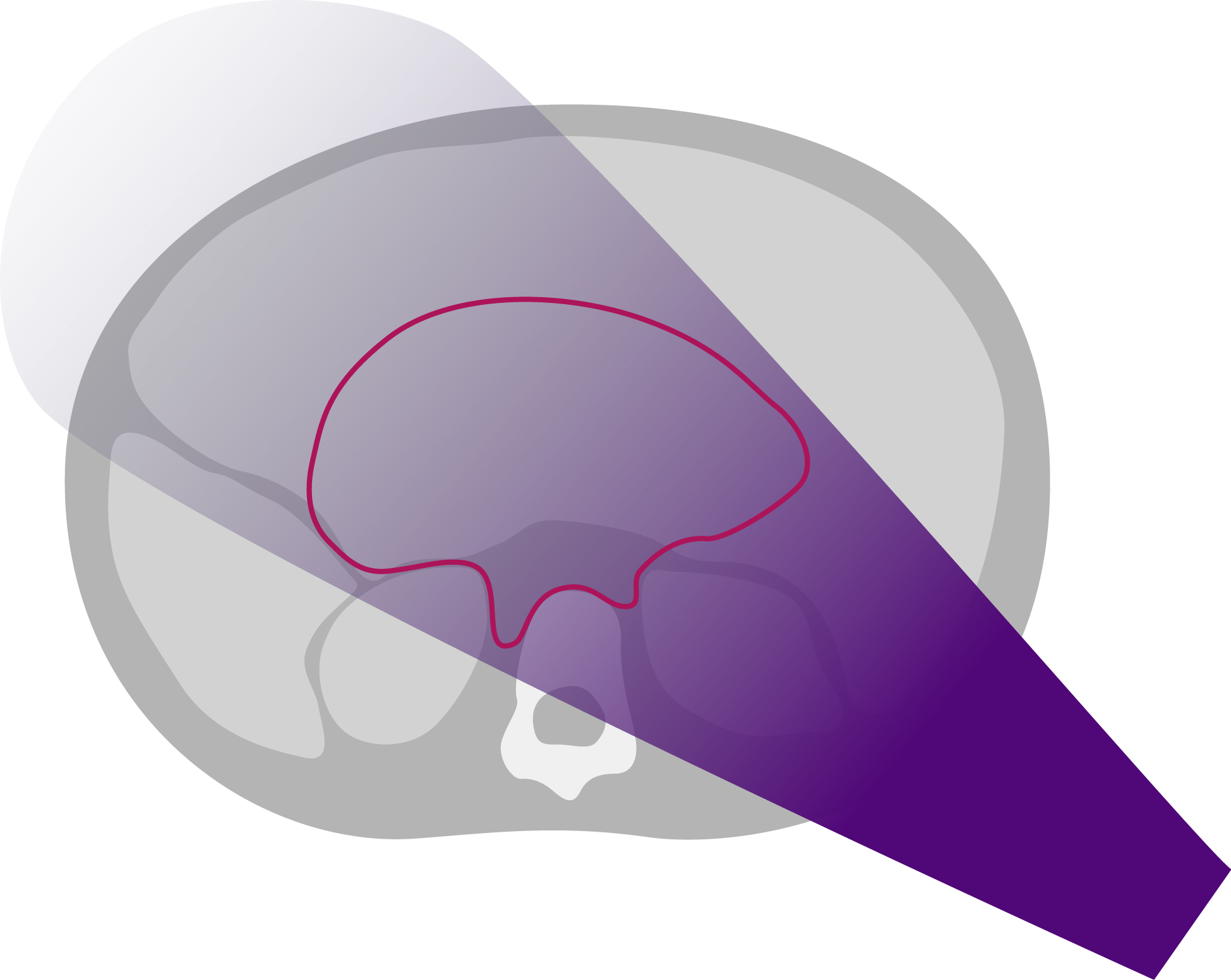Figures for a radiotherapy Patient Information Sheet – Graphical Science