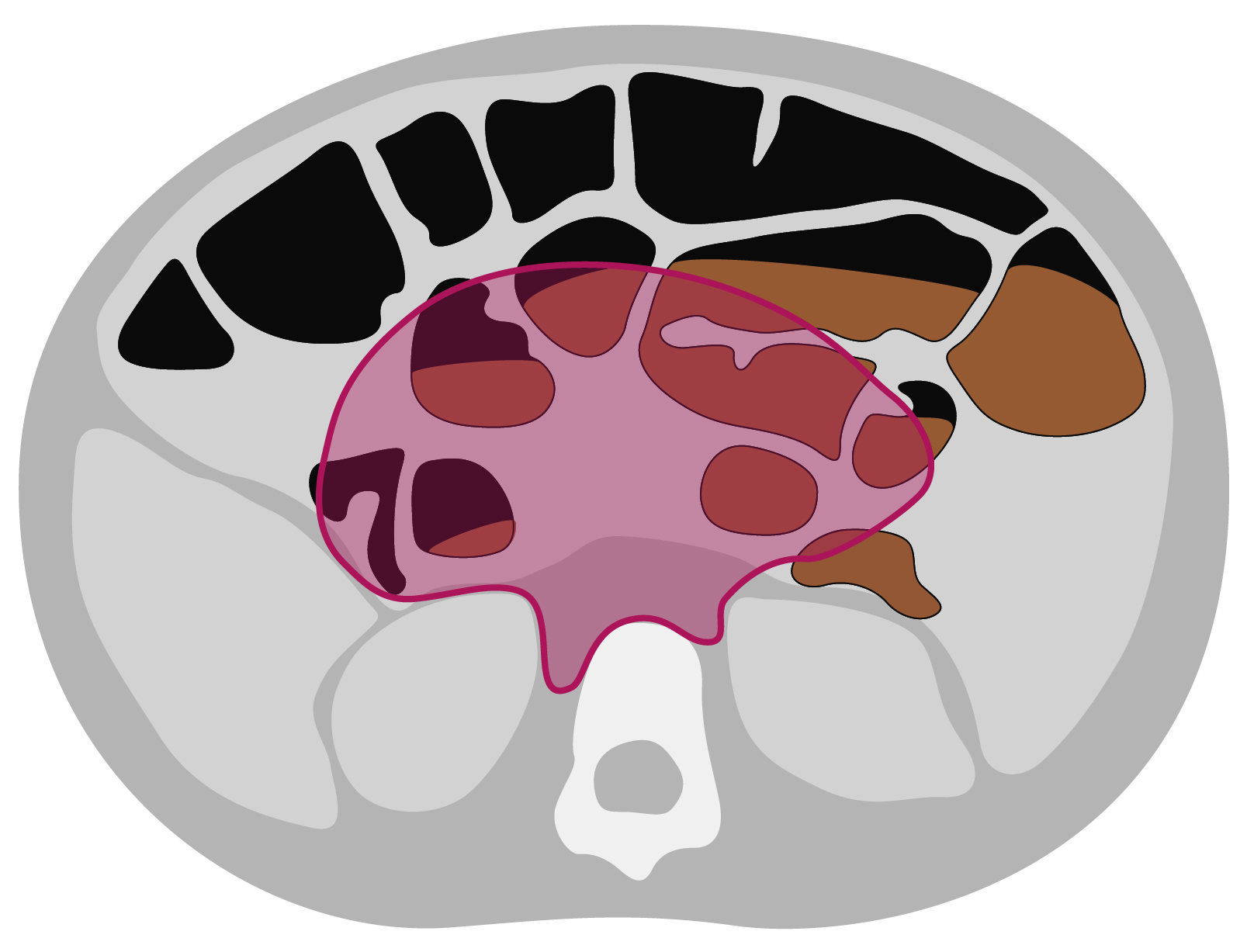 Figures for a radiotherapy Patient Information Sheet – Graphical Science